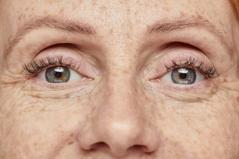 Tipos de olheiras: saiba quais são e como tratá-los