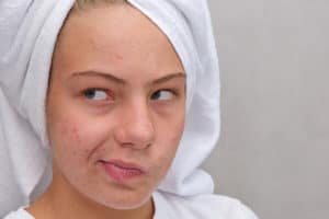 Mapa da acne: conheça a teoria e descubra se ela funciona
