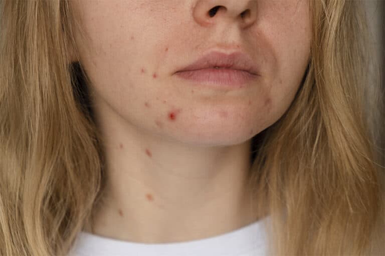 Acne adulta: confira as causas e os tratamentos