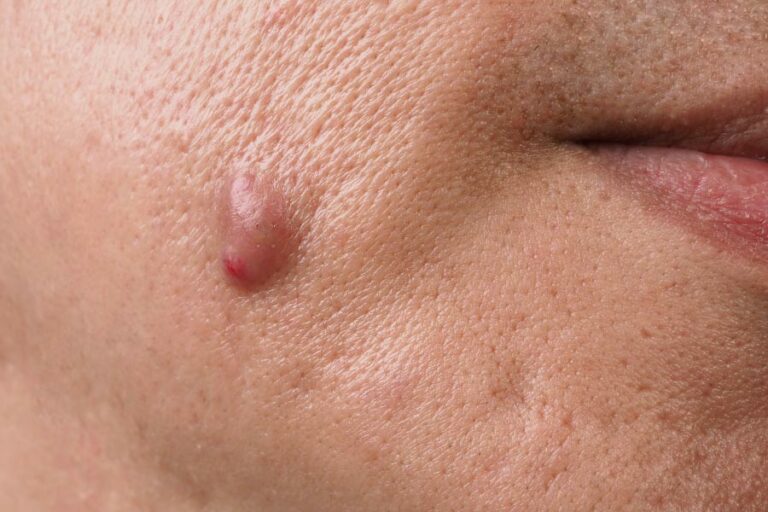 Acne grau 5: cuidados para uma pele mais bonita e saudável